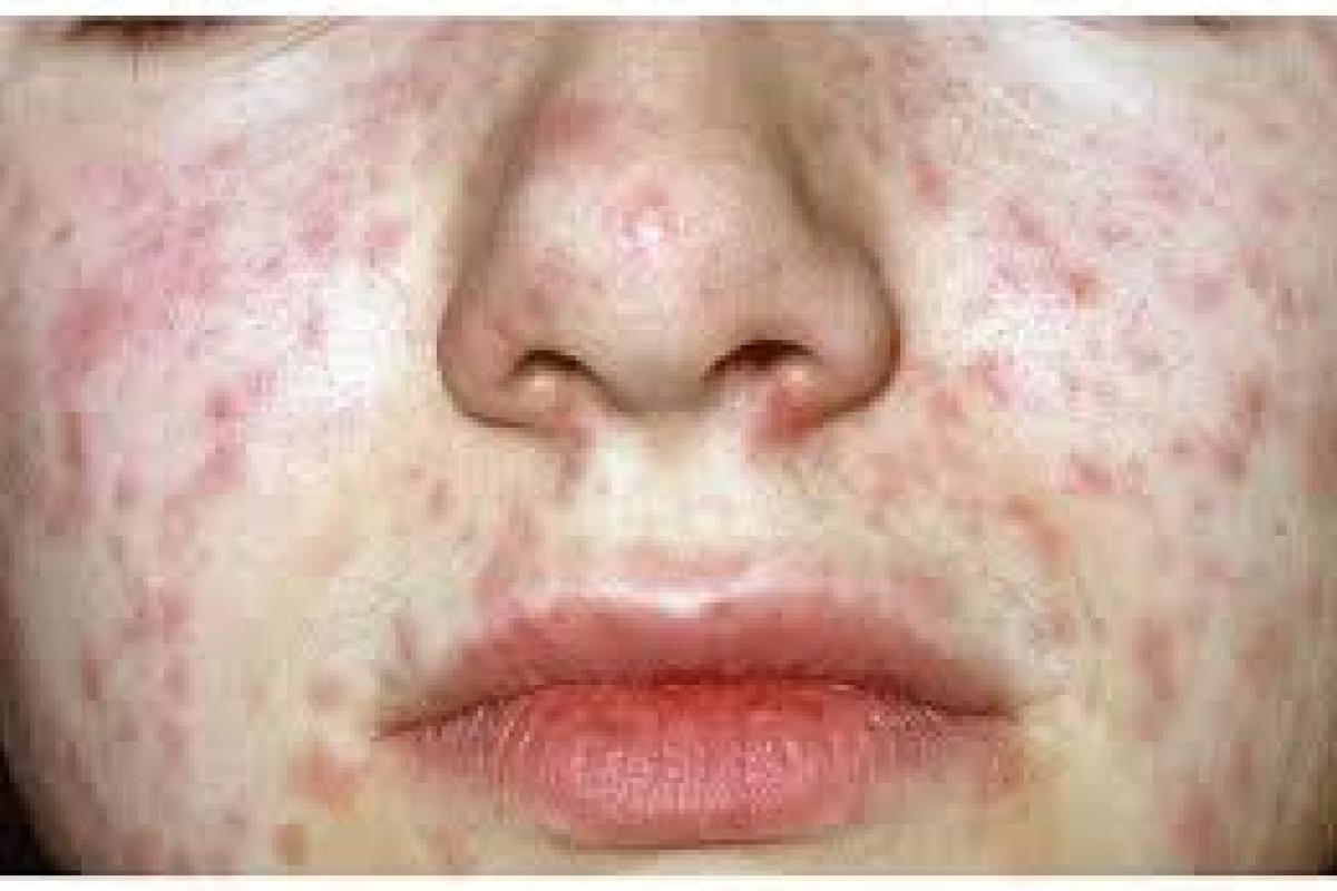 Sarampión podría propagarse como "amenaza inminente": OMS y CDC | BI ...